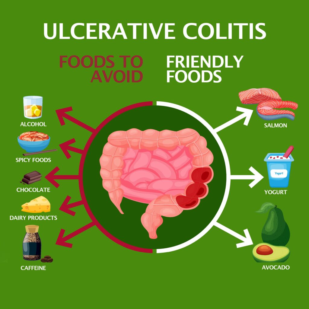 Ulcerative Colitis Condition | Gastroenterology of Greater Orlando