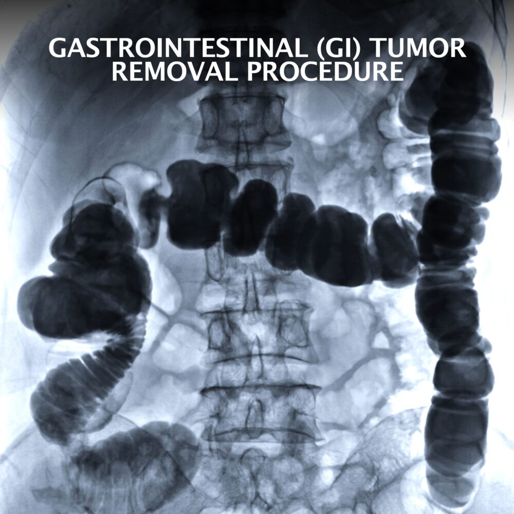 GI Tumor Removal Procedure | Gastroenterology of Greater Orlando