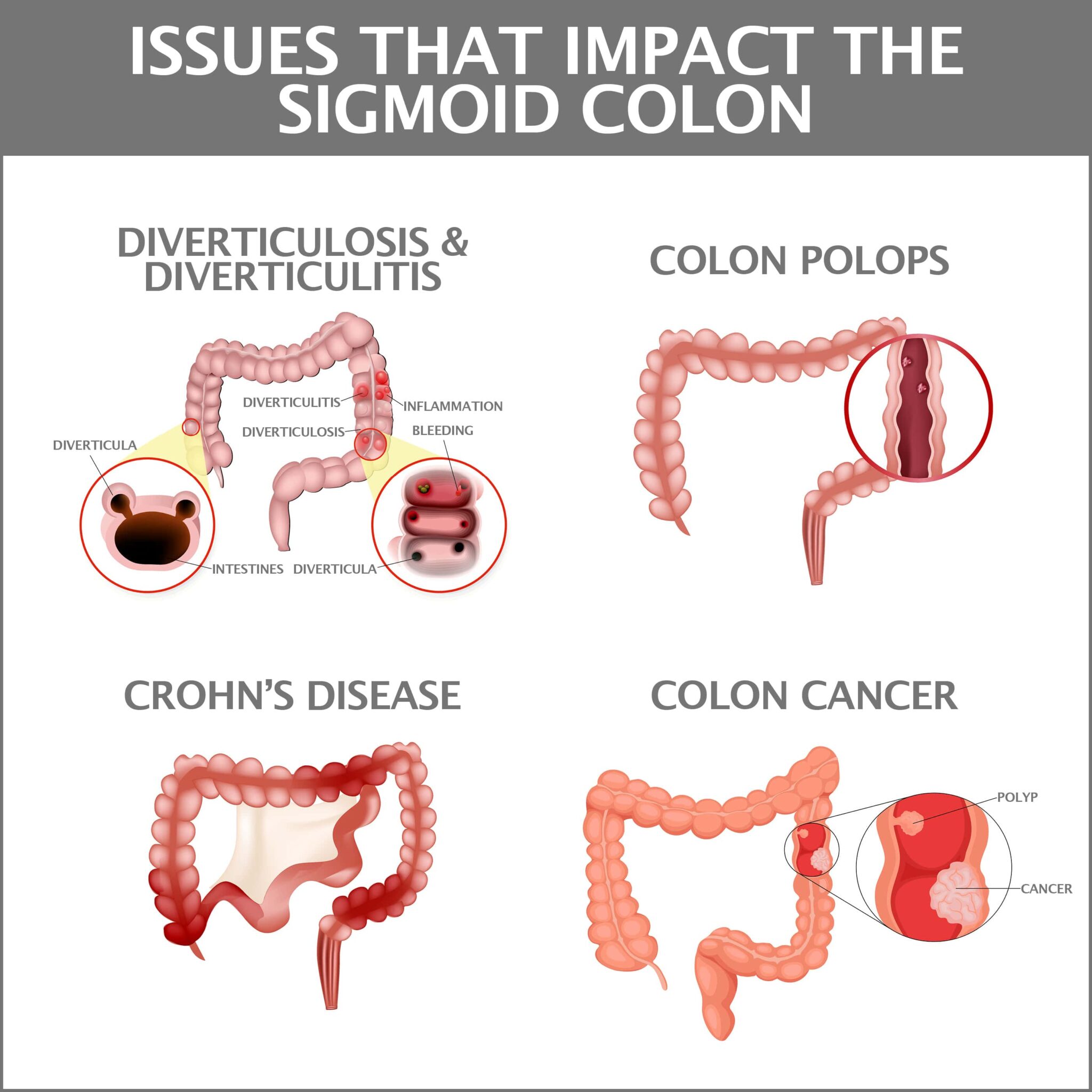 Sigmoidoscopy Procedure | Gastroenterology of Greater Orlando