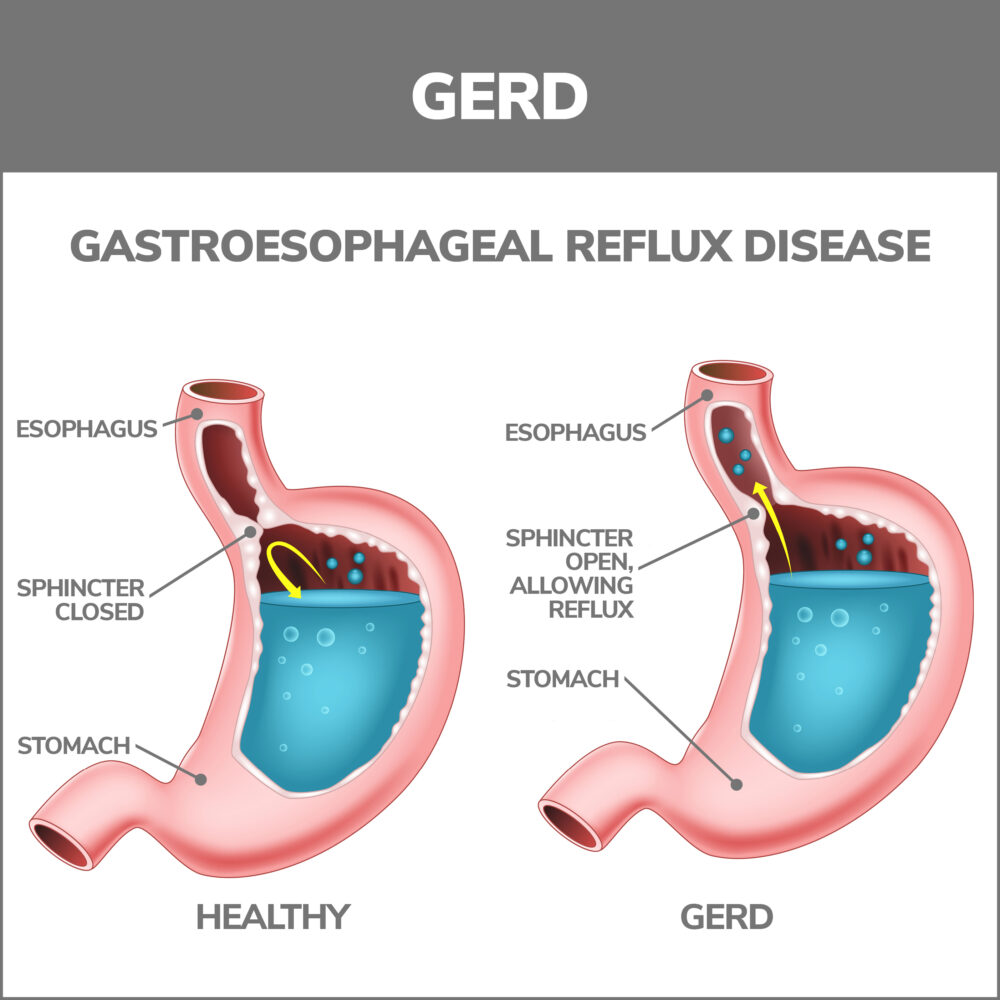 Esophageal Disorders | Gastroenterology of Greater Orlando
