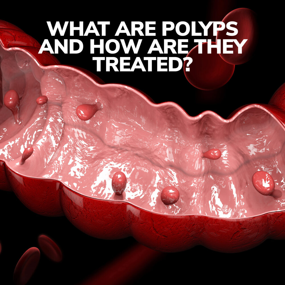 What are Polyps? | Gastroenterology of Greater Orlando