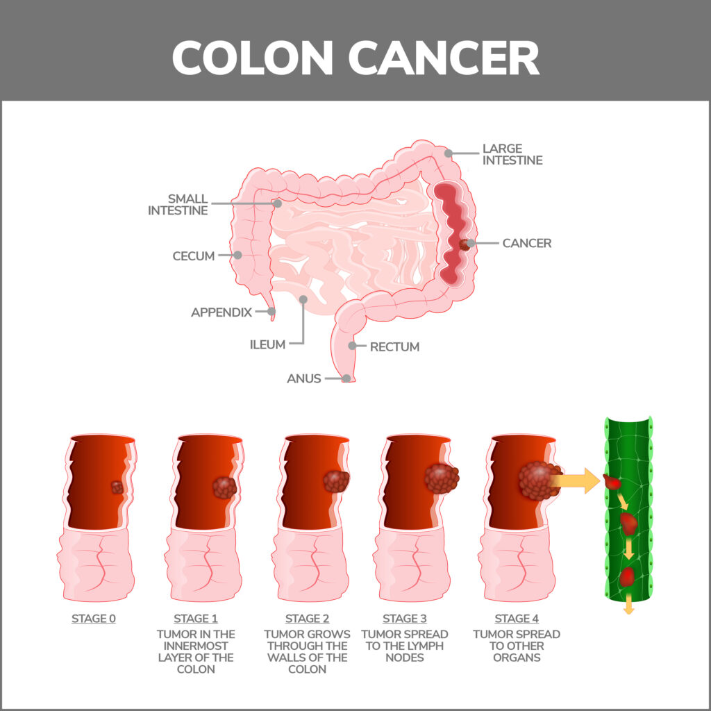 What are Polyps? | Gastroenterology of Greater Orlando