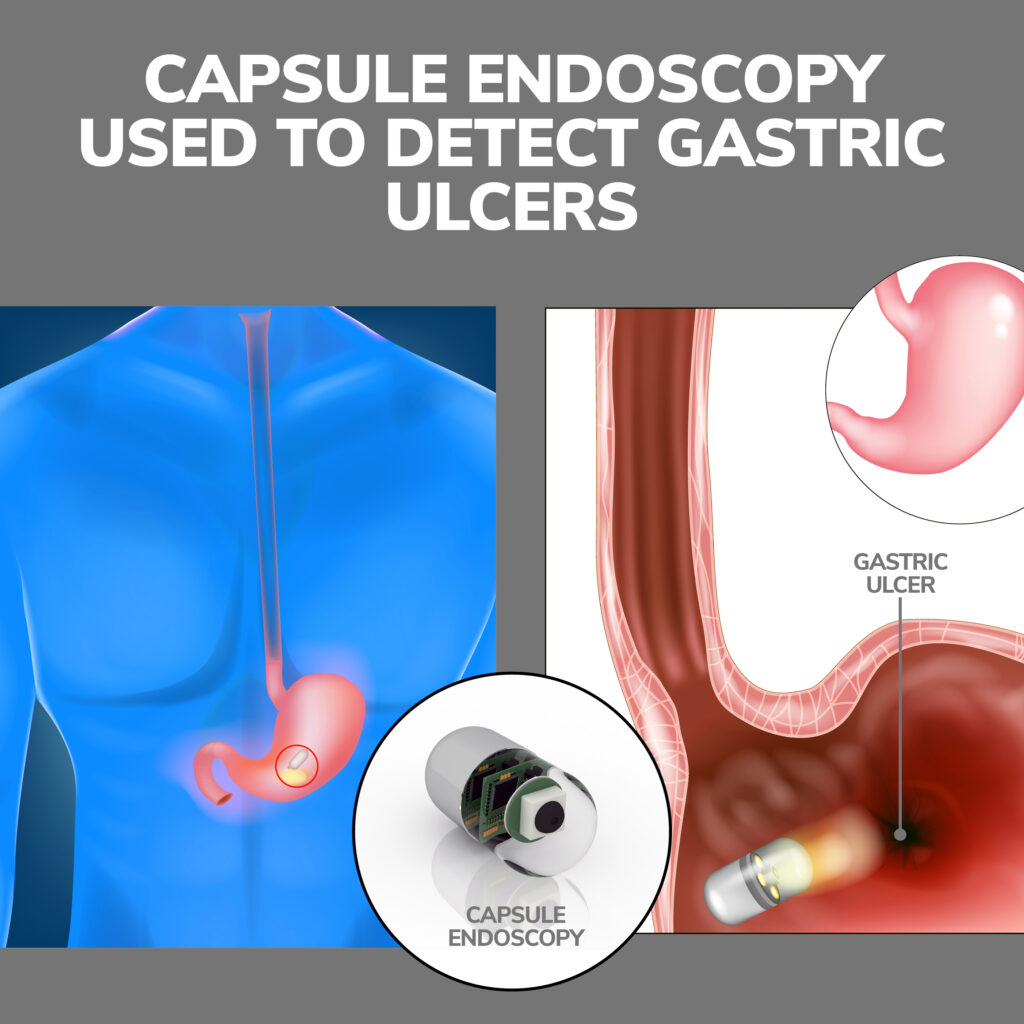 Capsule Endoscopy vs. Colonoscopy | Gastroenterology Orlando