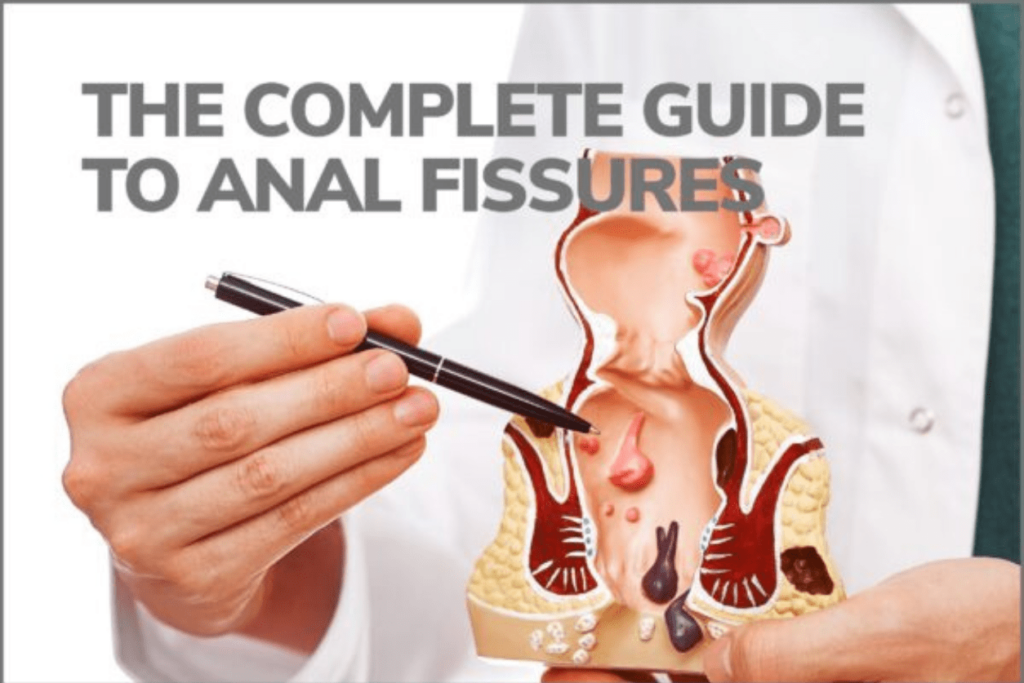 The Complete Guide to Anal Fissures and How to Treat Them