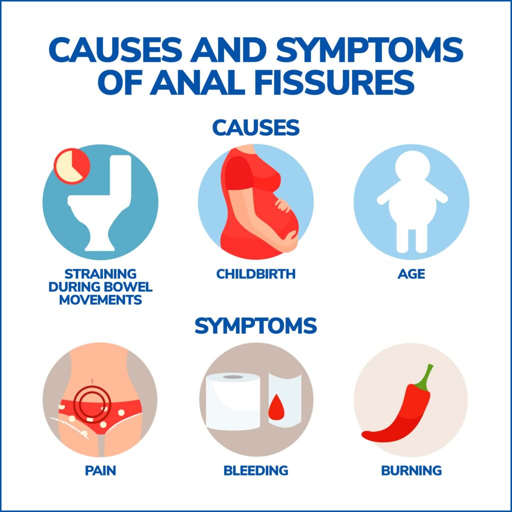 The Complete Guide To Anal Fissures And How To Treat Them